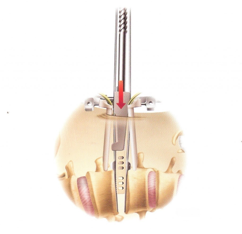 Extreme Lateral Minimally Invasive Fusion (XLif) - Spinecare Medical Group